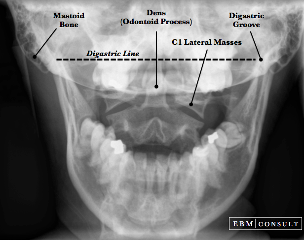 Open Mouth Odontoid Radiograph Xray